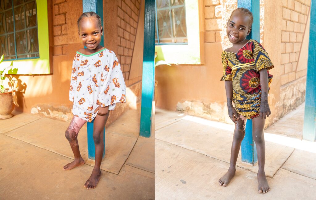 Burn Contractures - CURE Niger