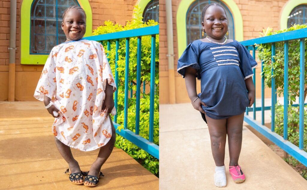 Bowed Legs - CURE Niger